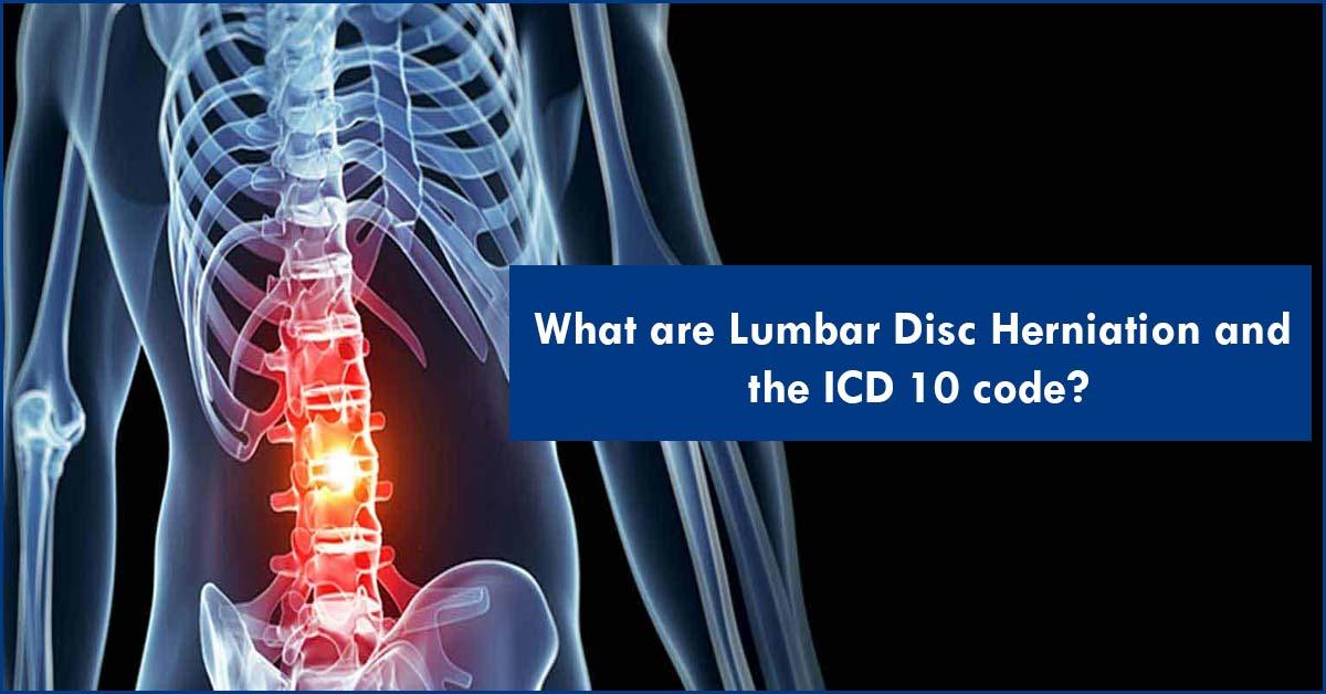 Other Intervertebral Disc Displacement Lumbar Region 56 OFF Other Intervertebral Disc Displacement Lumbar Region 56 OFF